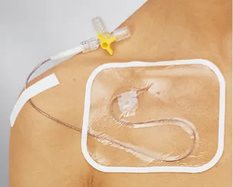 Повязка самоклеящаяся Курагард / Curagard АР, для фиксации катетеров ...